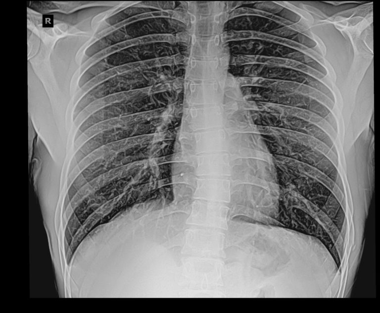 Chest-Sharp-AP-2-Broken-Rib | TI-BA Enterprises