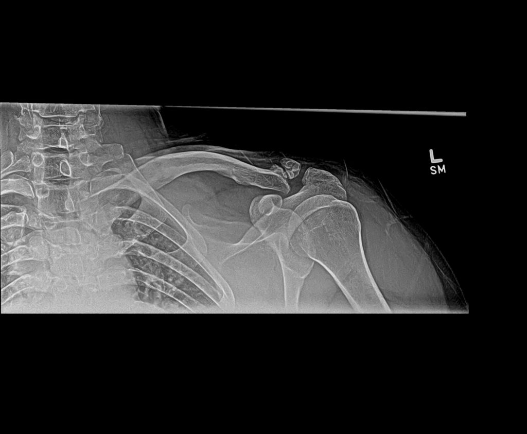 Clavicle-AP-2 | TI-BA Enterprises